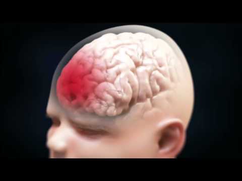 Shaken Baby Syndrome Brain Injury