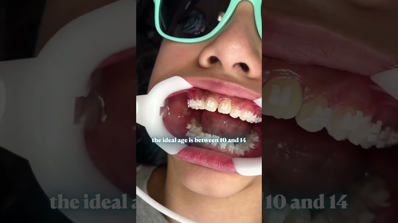 What's the best age to get braces?