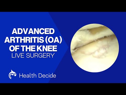 Advanced Arthritis (OA) of the Knee - Arthroscopic Surgery