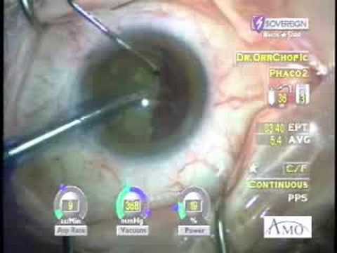 Cataract Surgery
