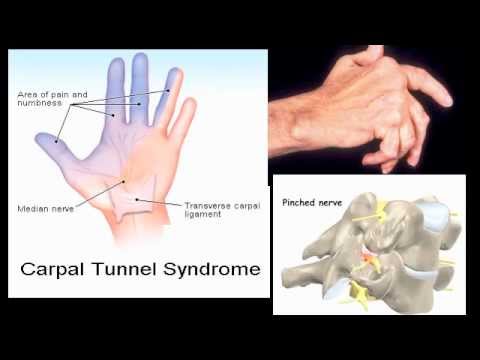Paresthesia