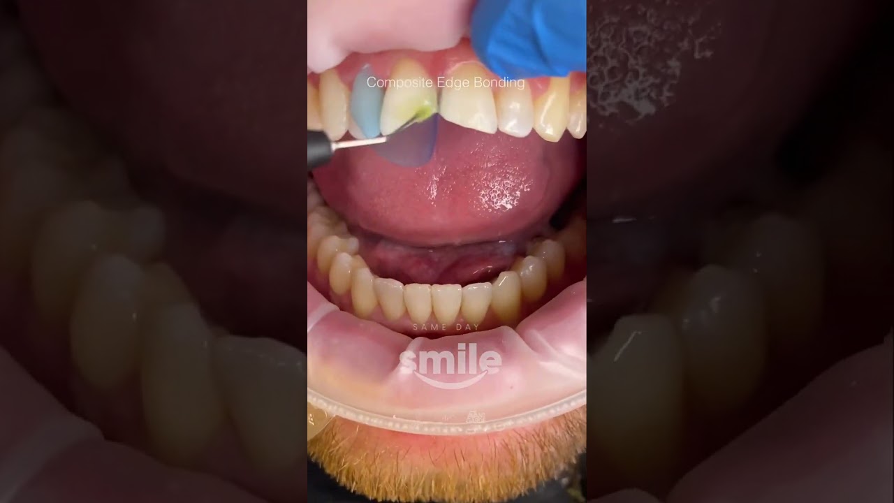 Composite edge bonding to repair chipped teeth✨ Such a drastic change for the patient #smilemakeover
