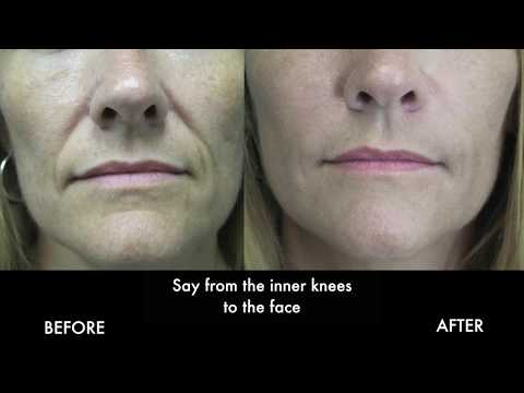 Fat Transfer to the Buttocks and Face, Tampa, FL