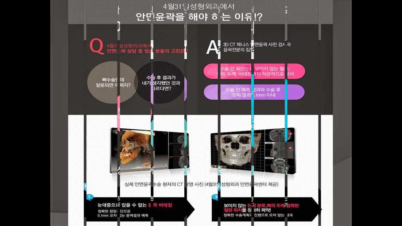 Korean Plastic Surgery / April31 PS Face Contouring / 3D Scan V-Line / Dr. Sung Wan Park