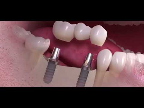 Le BRIDGE sur IMPLANTS dentaires - le pont dentaire sur implants