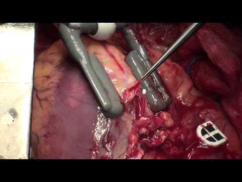 Open Heart Surgery Video