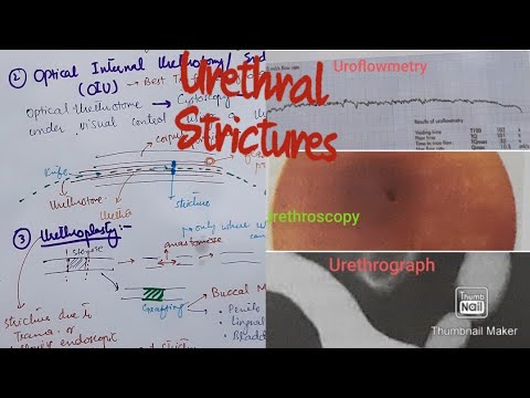 Urethral Strictures