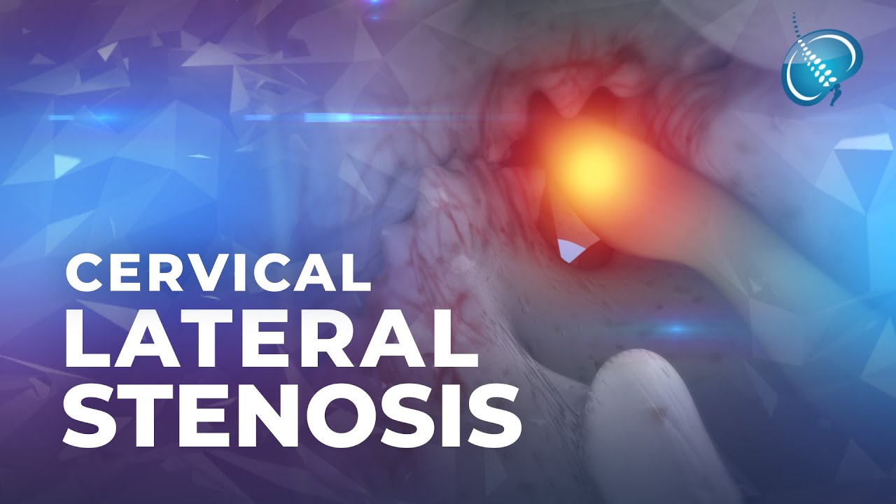 What is Cervical Lateral Stenosis? | Foraminal Stenosis