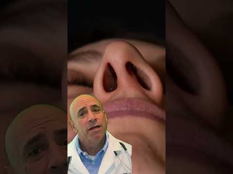 How do I know if I have a deviated septum?