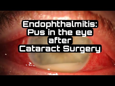 What is ENDOPHTHALMITIS/ Eye Infection #endophthalmitis