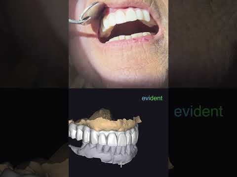 Dr.Casañas from Meadowbrook Dental Care takes control of his All-On-X workflow! | Dental CAD Design
