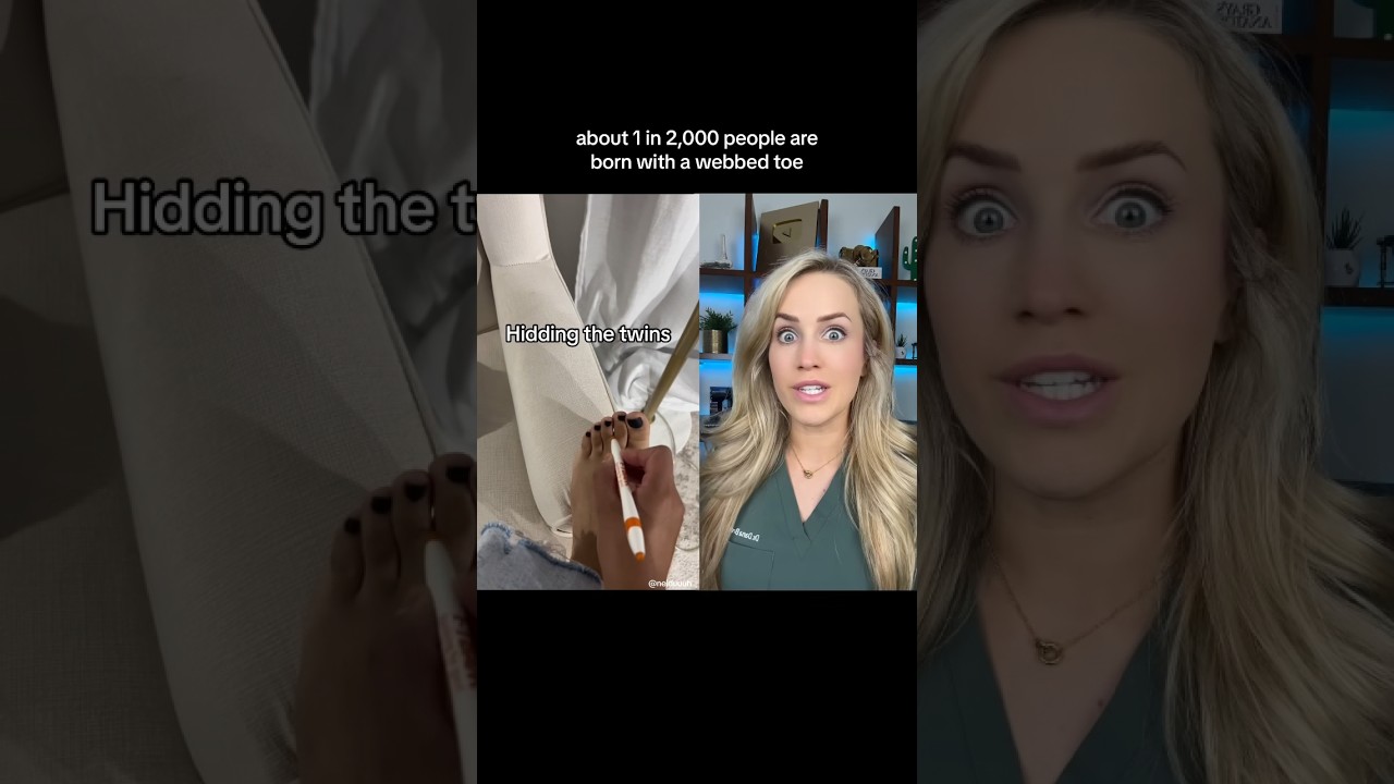 Doctor reacts: webbed toe