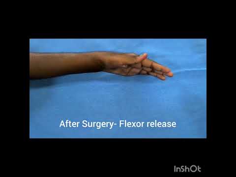 VIC- Volkmann's ischemic contracture- flexor pronator release