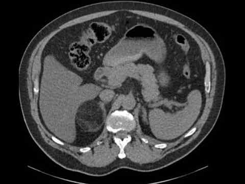 Case discussion 007 adrenal myelolipoma