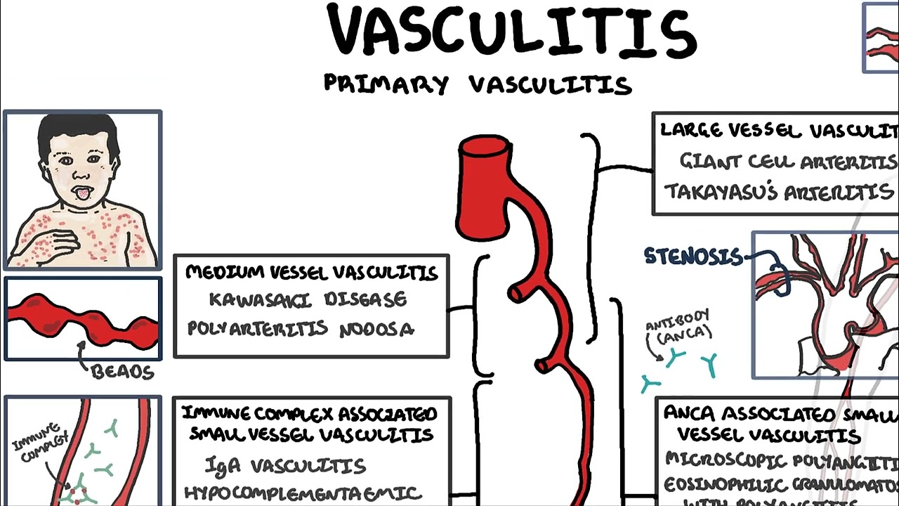 Vasculitis Overview - types and classification