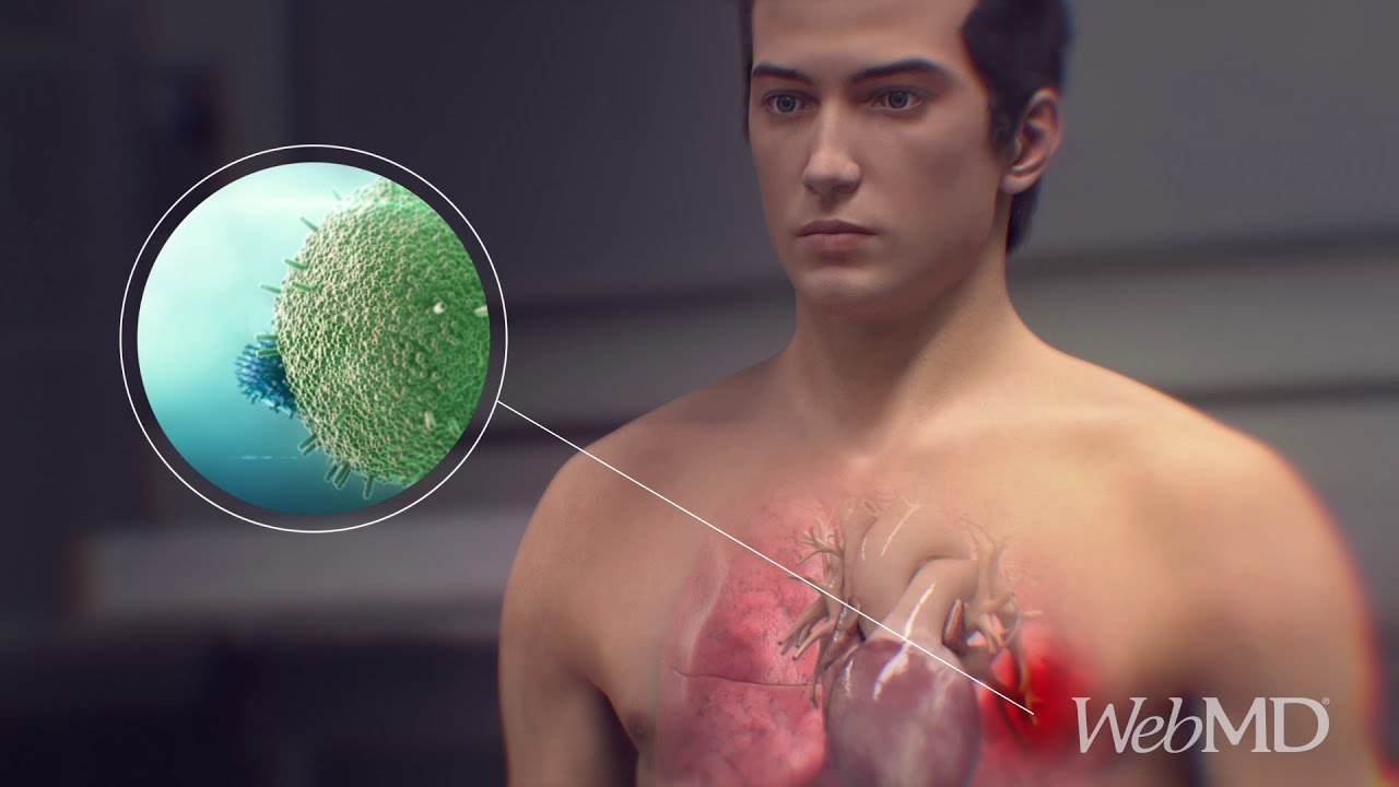 How Does Immunotherapy Fight Cancer? | WebMD