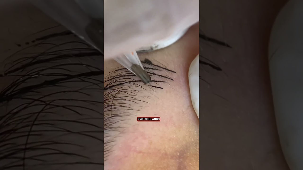 METODO DE NANOFIOS NO DERMÓGRAFO #shorts