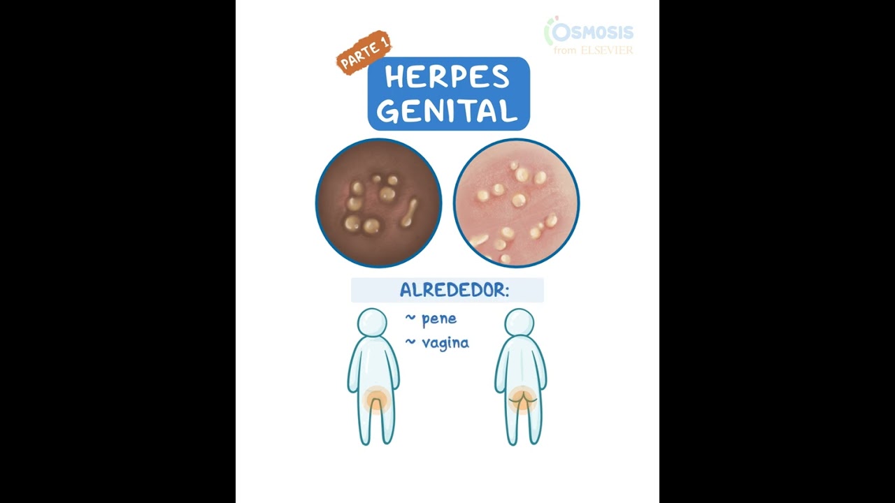 Herpes Genital