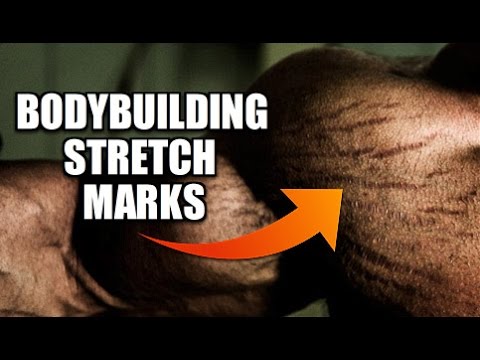 Bodybuilding Stretch Marks: Can They Be Eliminated?
