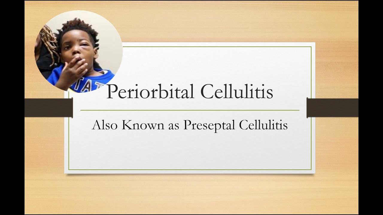 Periorbital Cellulitis Emergency