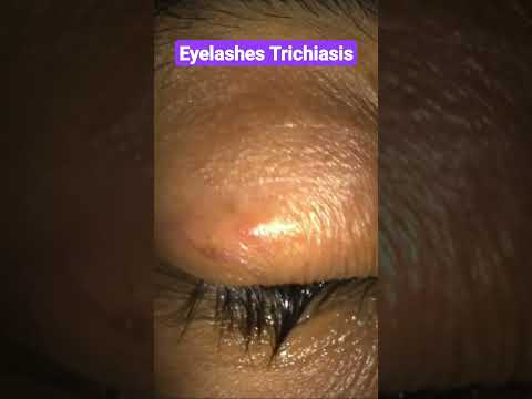 eyelashes Trichiasis