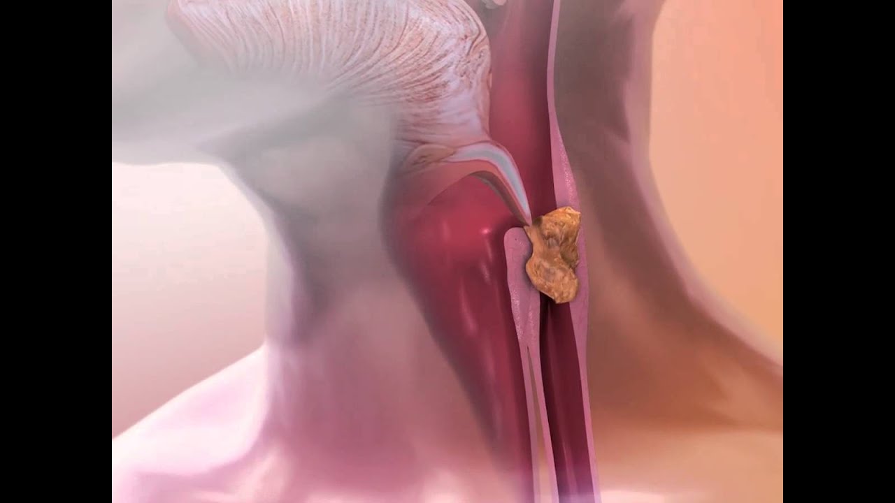How the Epiglottis Works: Learn@Visible Body
