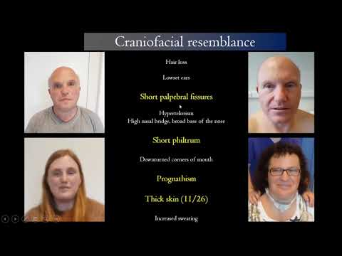 Adults Growing Up and Older with Myhre Syndrome by Dr Bert Callewaert