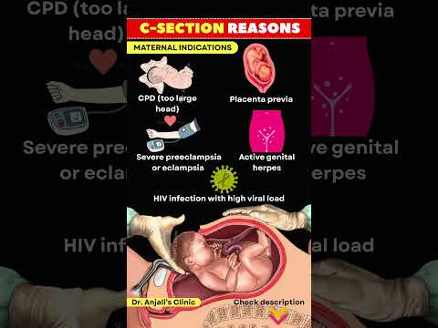 Top Maternal Reasons for C Section: When Cesarean Delivery Is the Safer Choice for Moms