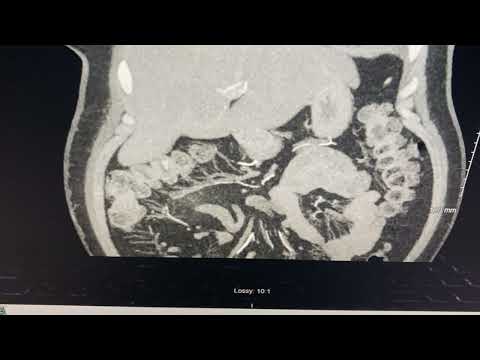 CT Scan of a Calcified Adrenal Mass with Dr. Tobias Carling