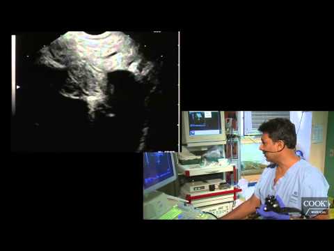 Possible Submucosal Tumor - Dr. Anand Sahai MD