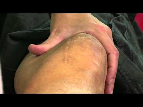 Effusion - Patellar Tap