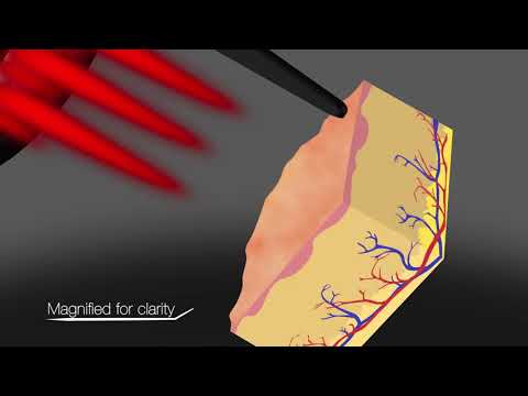 Cynosure: Picosure - Focus