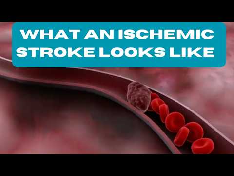 Ischemic Stroke Illustration