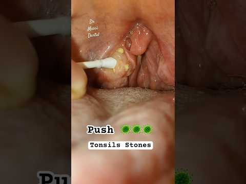 Remove the tonsils Stones