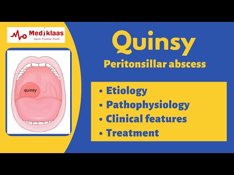 Quinsy - Peritonsillar abscess | Etiology, clinical features, treatment |Mediklaas