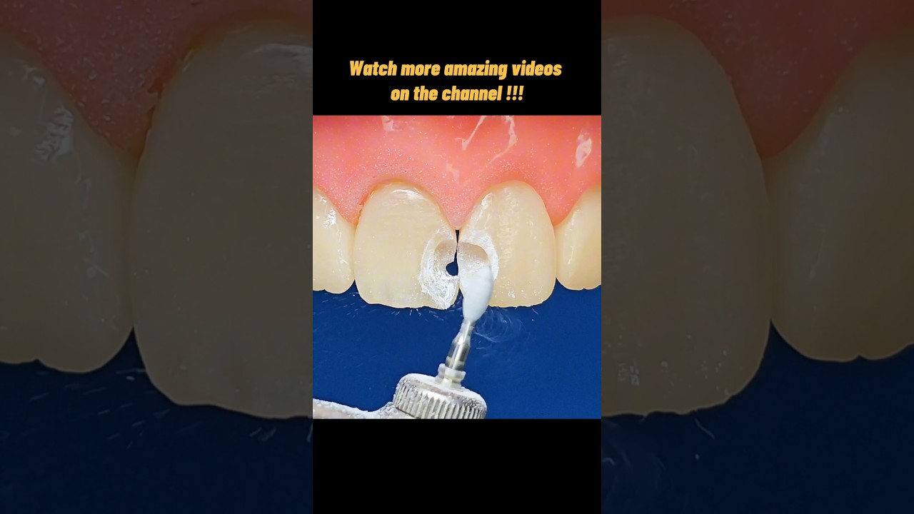 incredible restoration of decayed front teeth!!