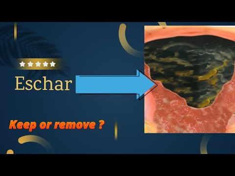 Should you Keep  or Remove an Eschar on a Wound : The decision-making process discussed .