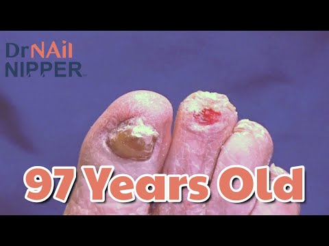 97 Year Old Toenails Trimmed in Almost 2 YEARS. FEET-ure Friday (2021)
