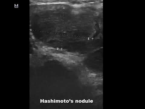 CASE 632 Hashimoto’s thyroiditis