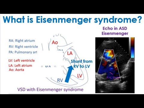 What is Eisenmenger syndrome?