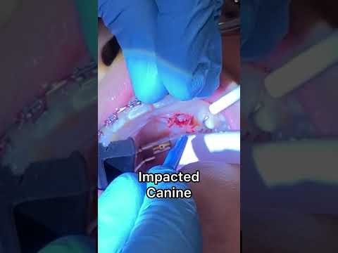 Exposed and Bond procedure - Impacted Canine - Video 6 Tooth Time Family Dentistry New Braunfels TX