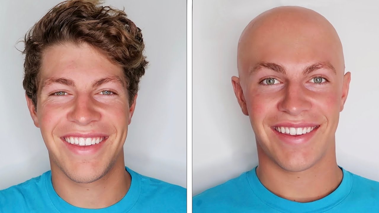 I Went Bald