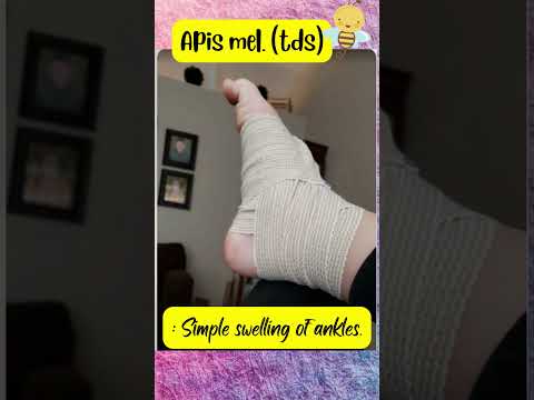 Apis Mellifica Homeopathic Medicine ||Managing Ankle Swelling with Apis Mel 30,200.