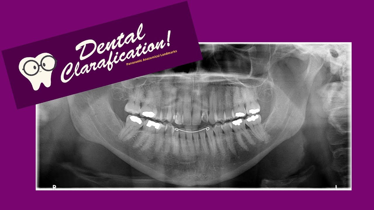 Anatomical Landmarks Found in a Panoramic Radiograph