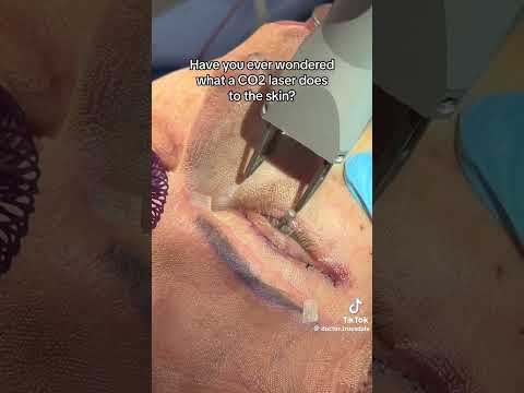 Ever wonder what a Co2 Laser does to the skin? CHECK THIS OUT
