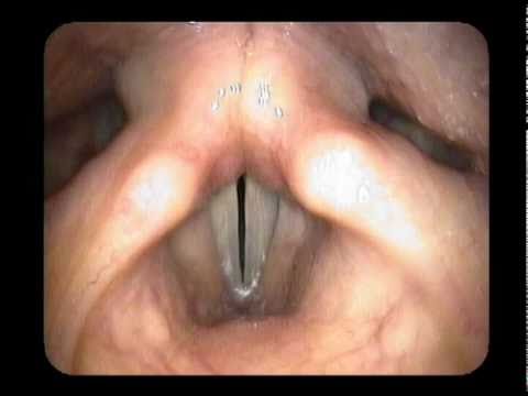Upper Airway Anatomy During Trans-Nasal Endoscopy (HD)