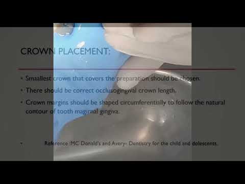 A complete clinical guide on stainless steel crown placement in primary teeth