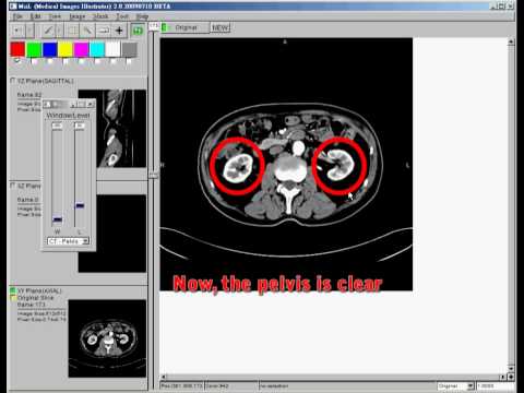 MiiL Tutorial : Window Level