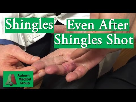 Shingles on the Hand Even After Shingles Shot | Auburn Medical Group