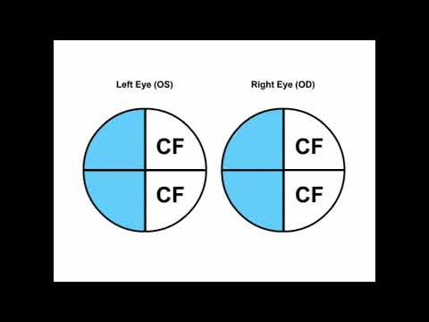 RS Visual Fields Part 1 - Performing The Tests
